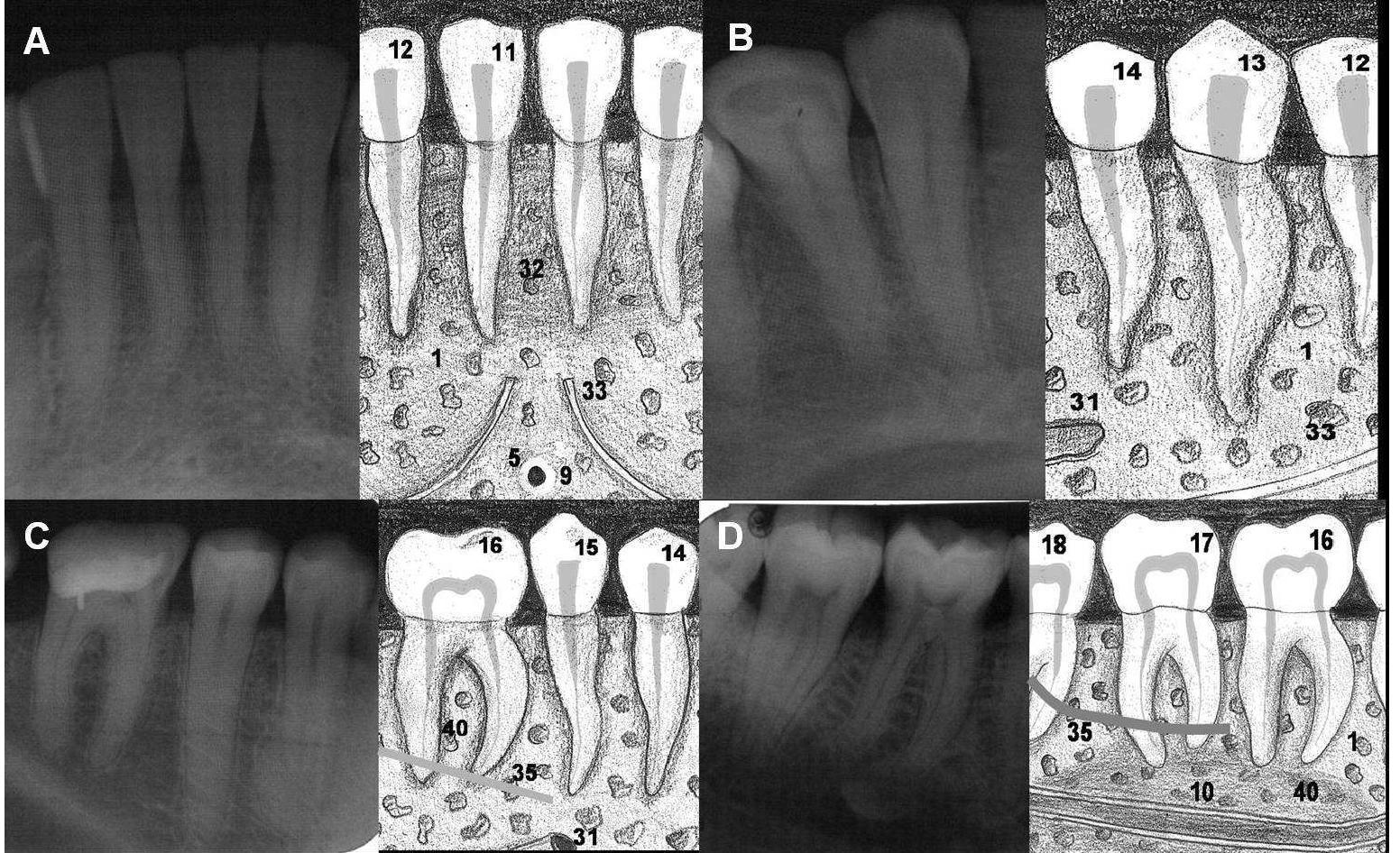 A: periapical view and schematic drawing of mandibular