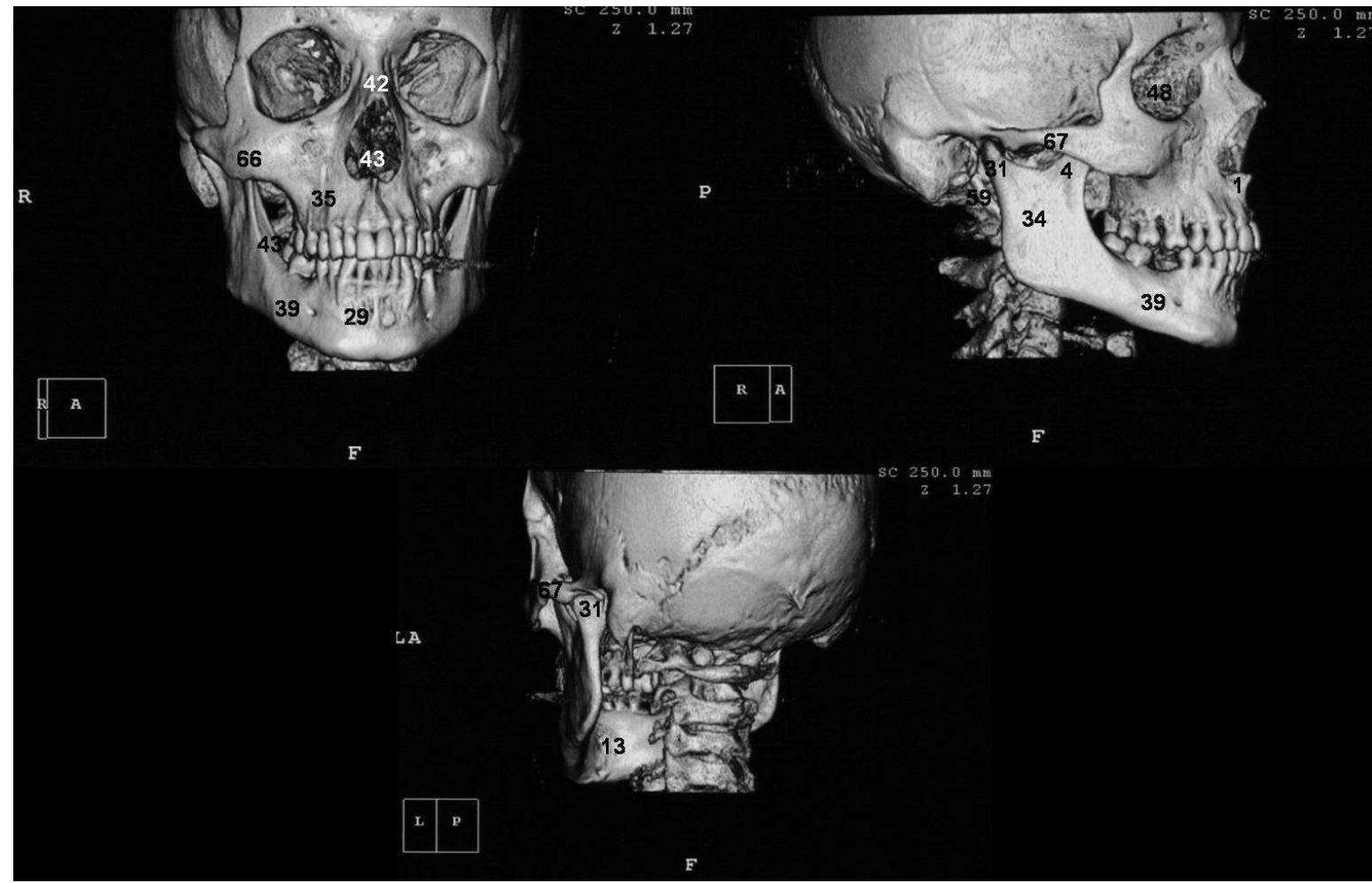 3d ct anatomy of the facial skeleton this chapter presents