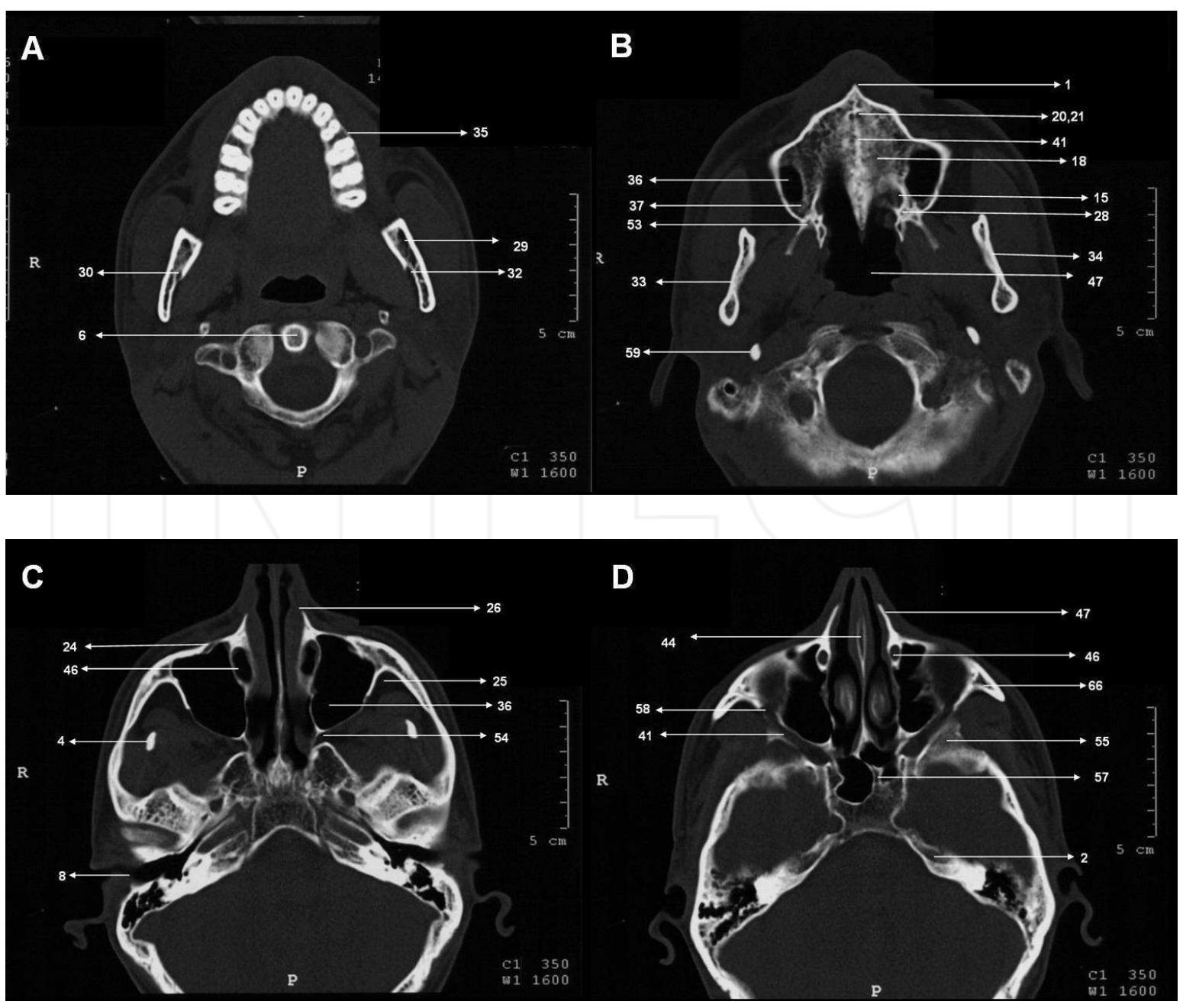 (a,b). axial ct anatomy of the facial skeleton; (c,d). axial