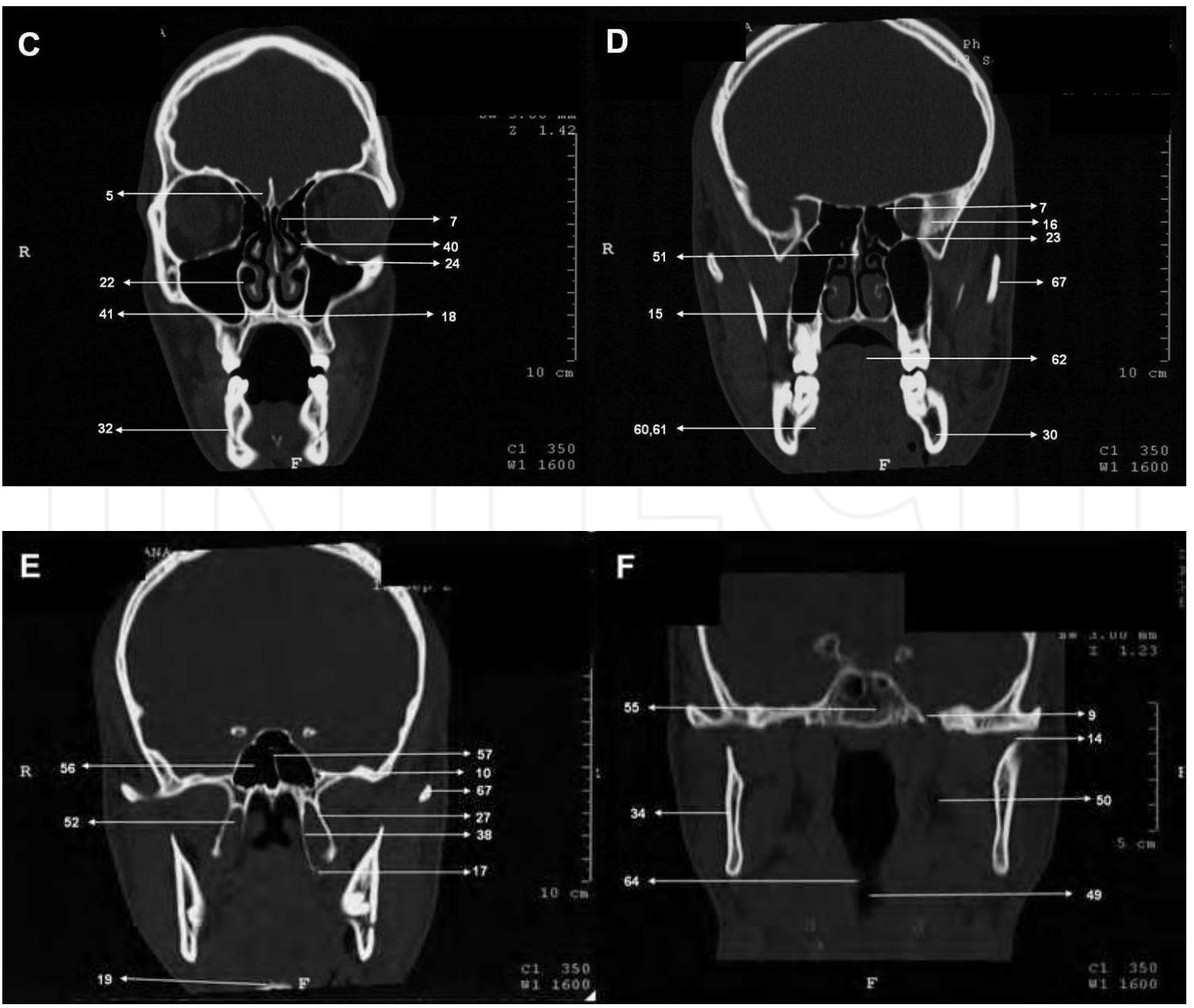 (a,b). coronal ct anatomy of the facial skeleton; (c,d).
