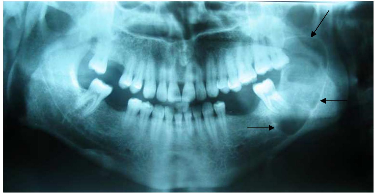 Panoramic radiograph shows an ellipsoid, expansile,