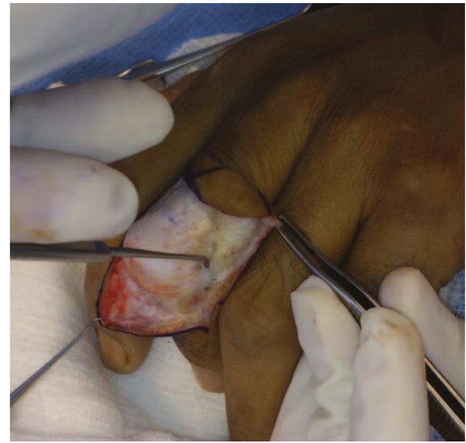 The transverse retinacular ligament on the left.