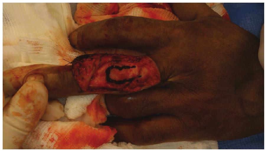 Marking of the central slip with methylene blue dye. however