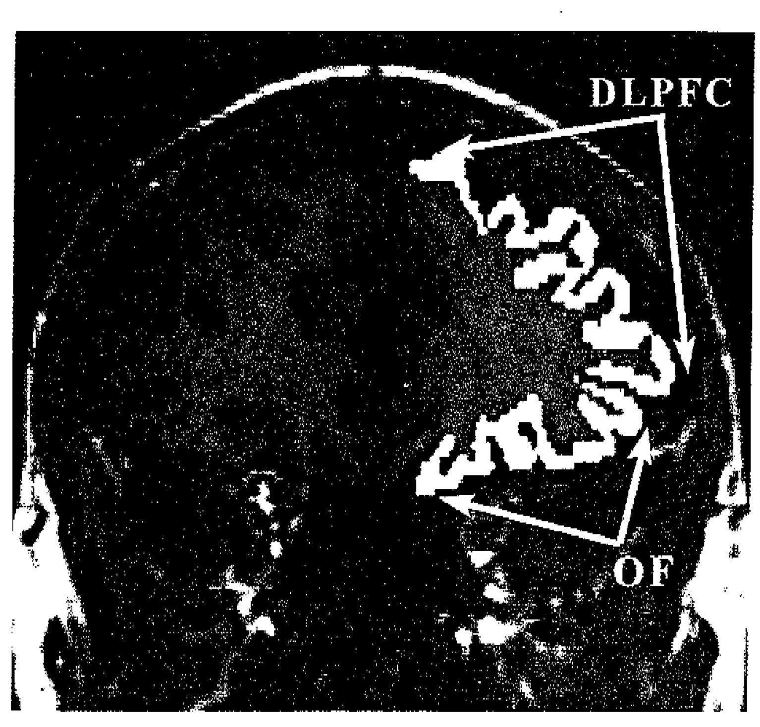7. a coronal slice through the rostral part of the brain