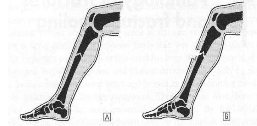 A: simple fracture b: compound fracture (craw- ford adams