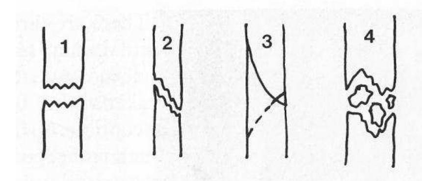 Frequent fracture patterns: 1. transverse (caused by direct