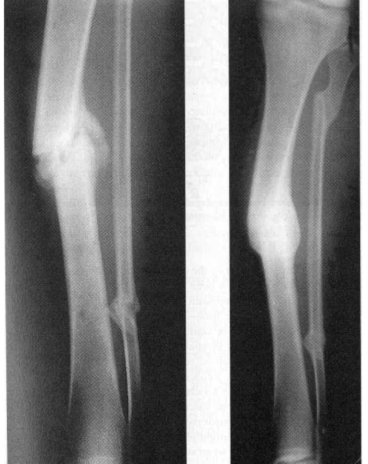 Left: fractured tibia and fibula sur- rounded by callus,
