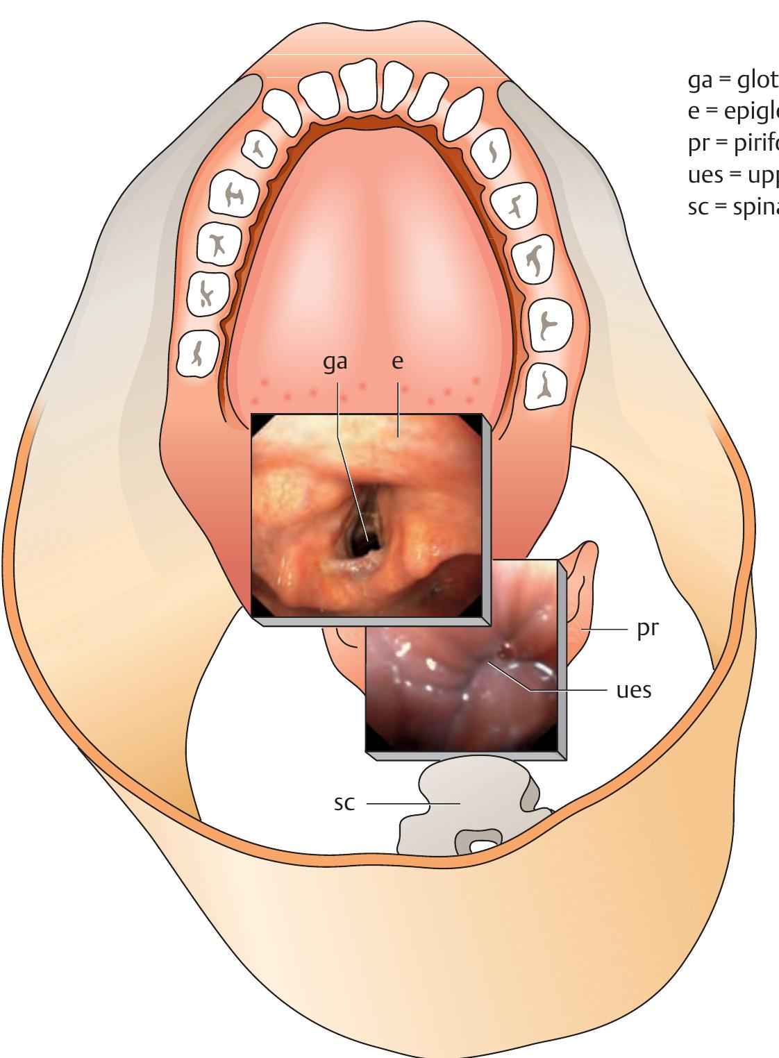 4 view of the trachea and upper esophageal sphincter. no-
