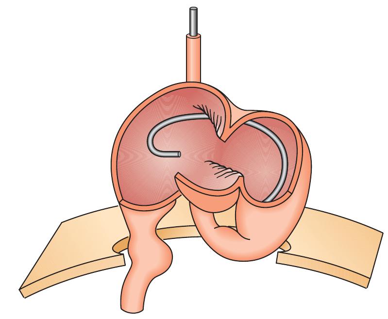 14 schematic diagram of upside-down stomach. complete