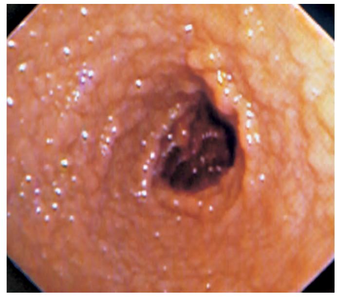 148 polypoid lesions in the duodenum a heterotopic gastric