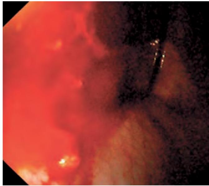 23 clipping of a bleeding biopsy) site a brisk bleeding