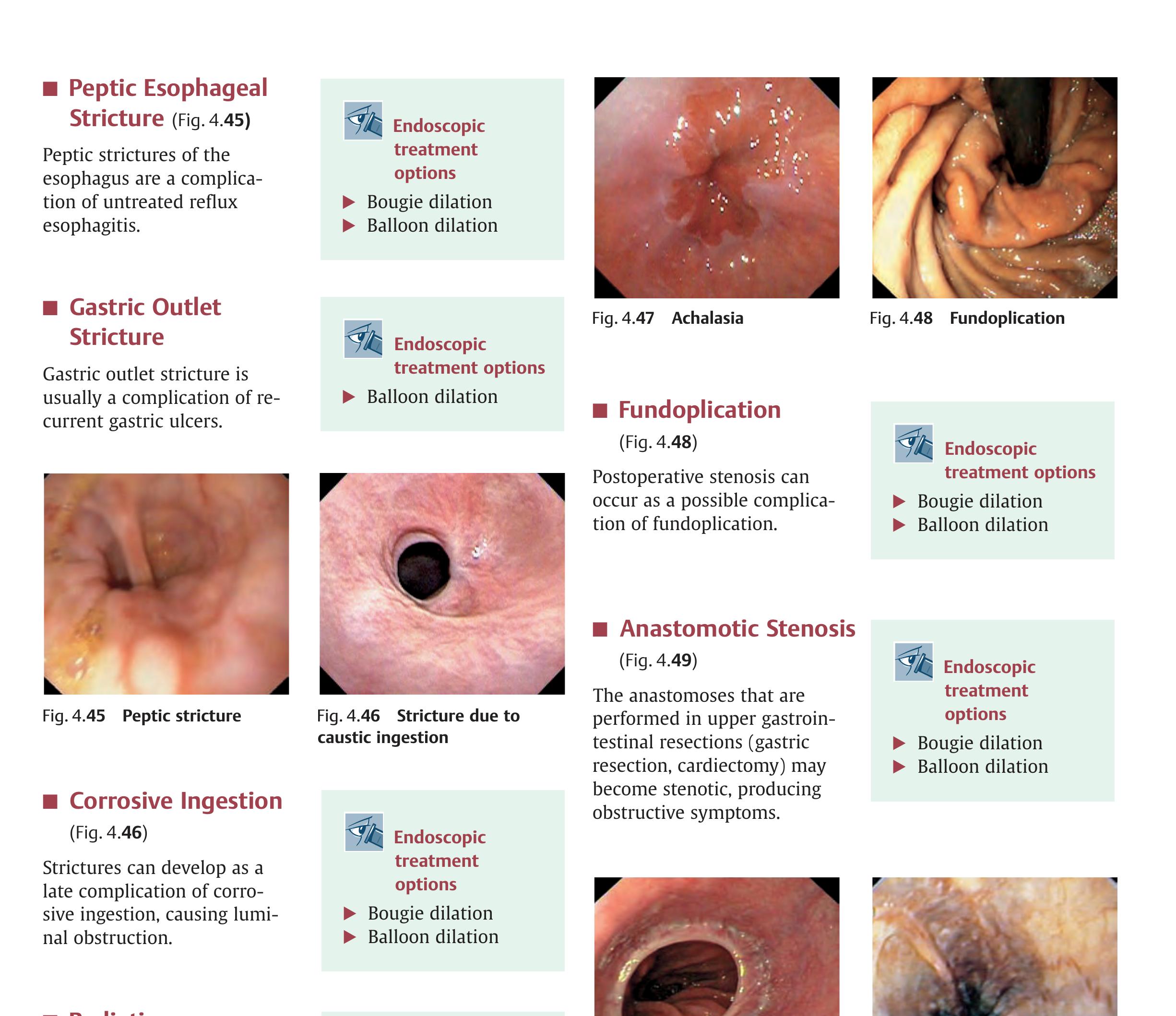 Radiation injury of the esophagus following radi- otherapy