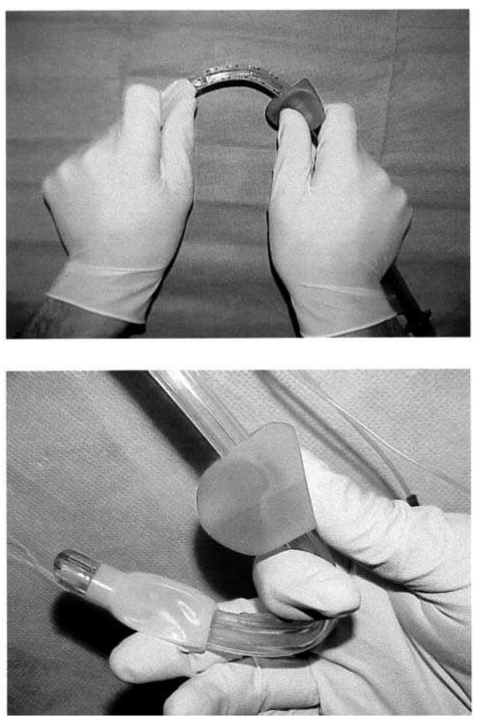 Original (above) and modified (below) lipp maneuver.