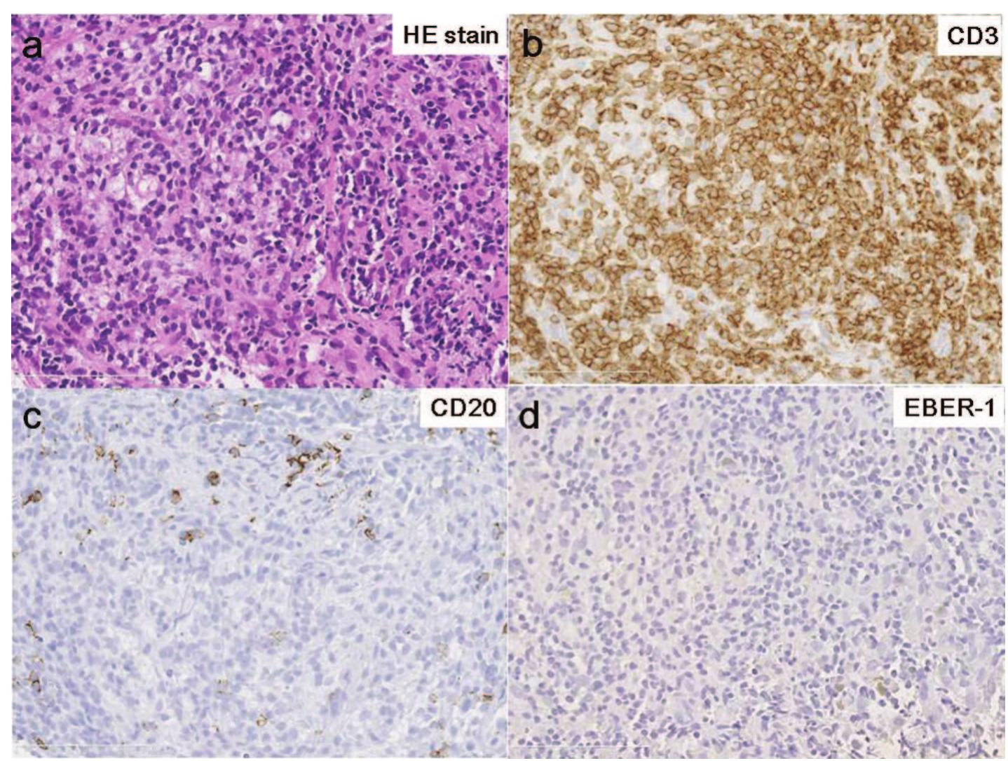 Pathology of axillary lymph nodes. histology of biopsy