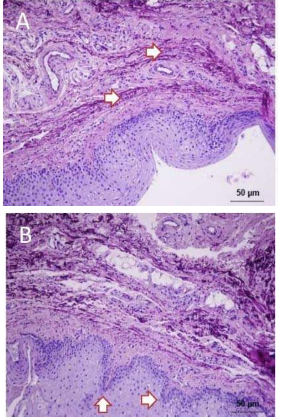 Photomicrograph of short lingual frenulum. bundles of