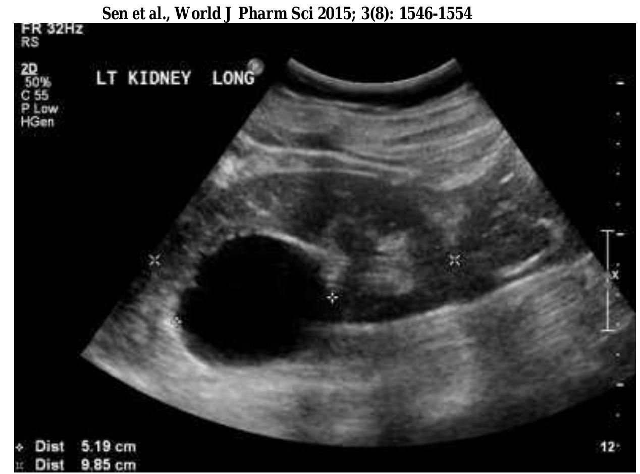 -5: ct scan of nephron in hydronephrosis