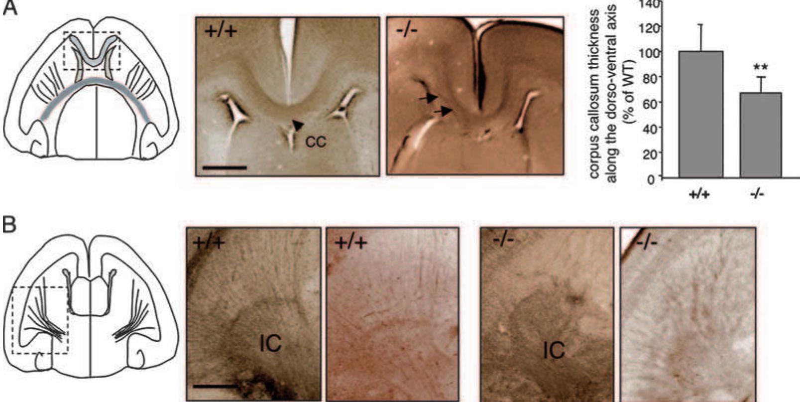 Defects in the corpus callosum and internal capsule in