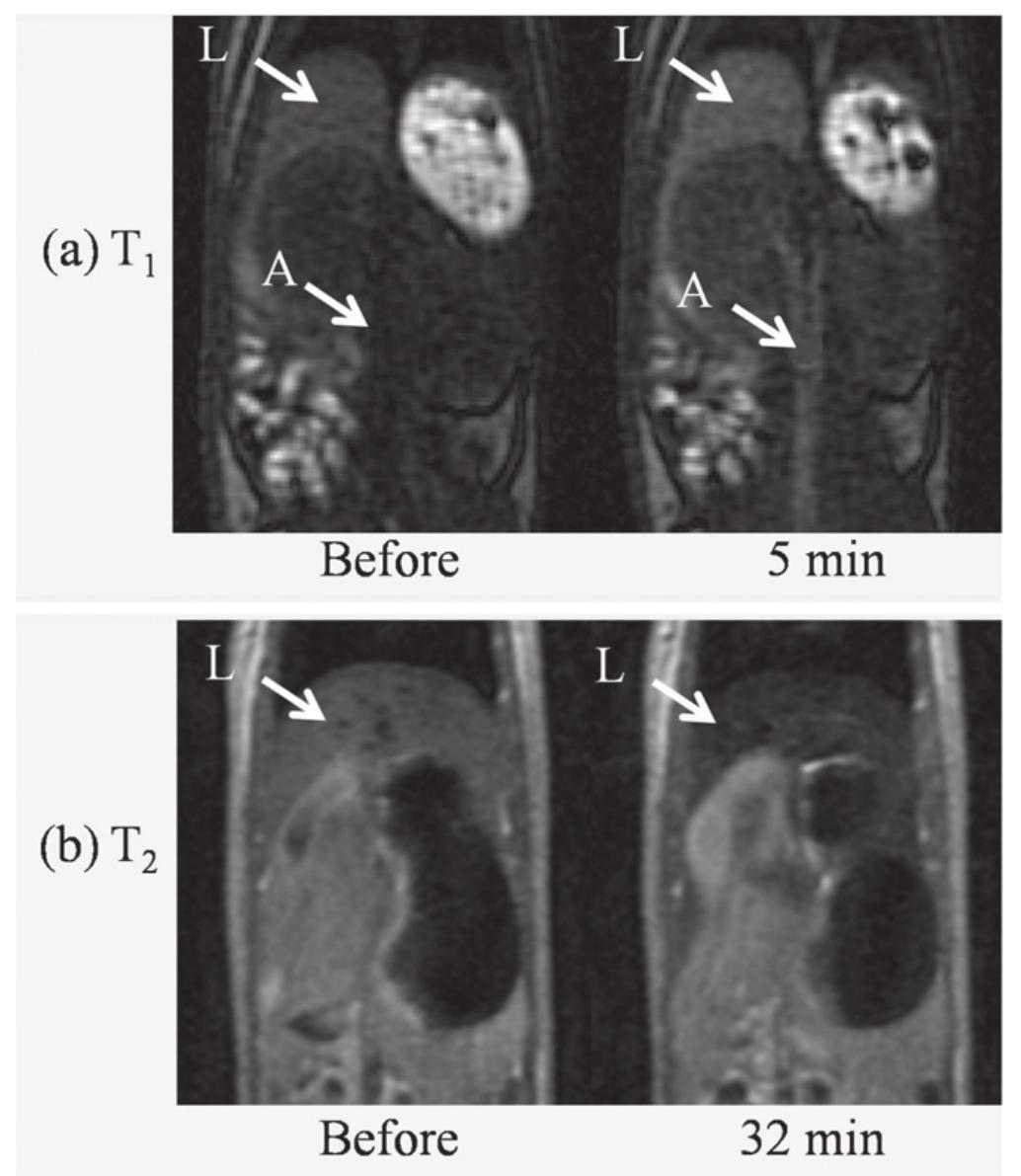 (a) jn vivo coronal t,; mr images of the liver (labeled ‘l’)