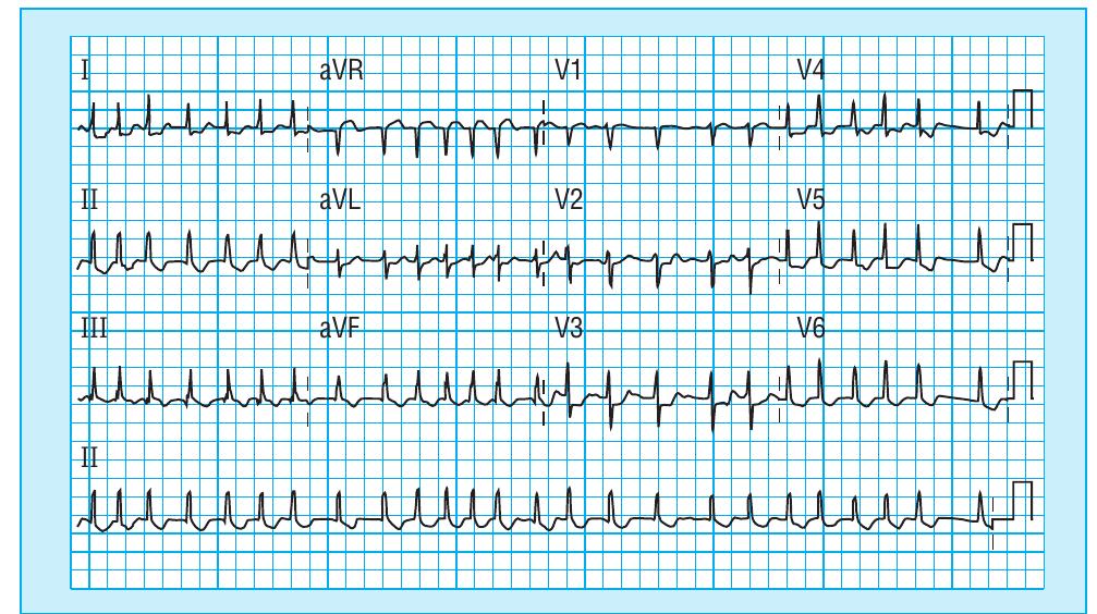 Electrocardiogram showing atrial fibrillation with a rapid