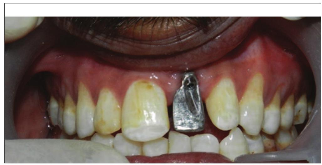 Custom cast abutment with the abutment screw in place figure