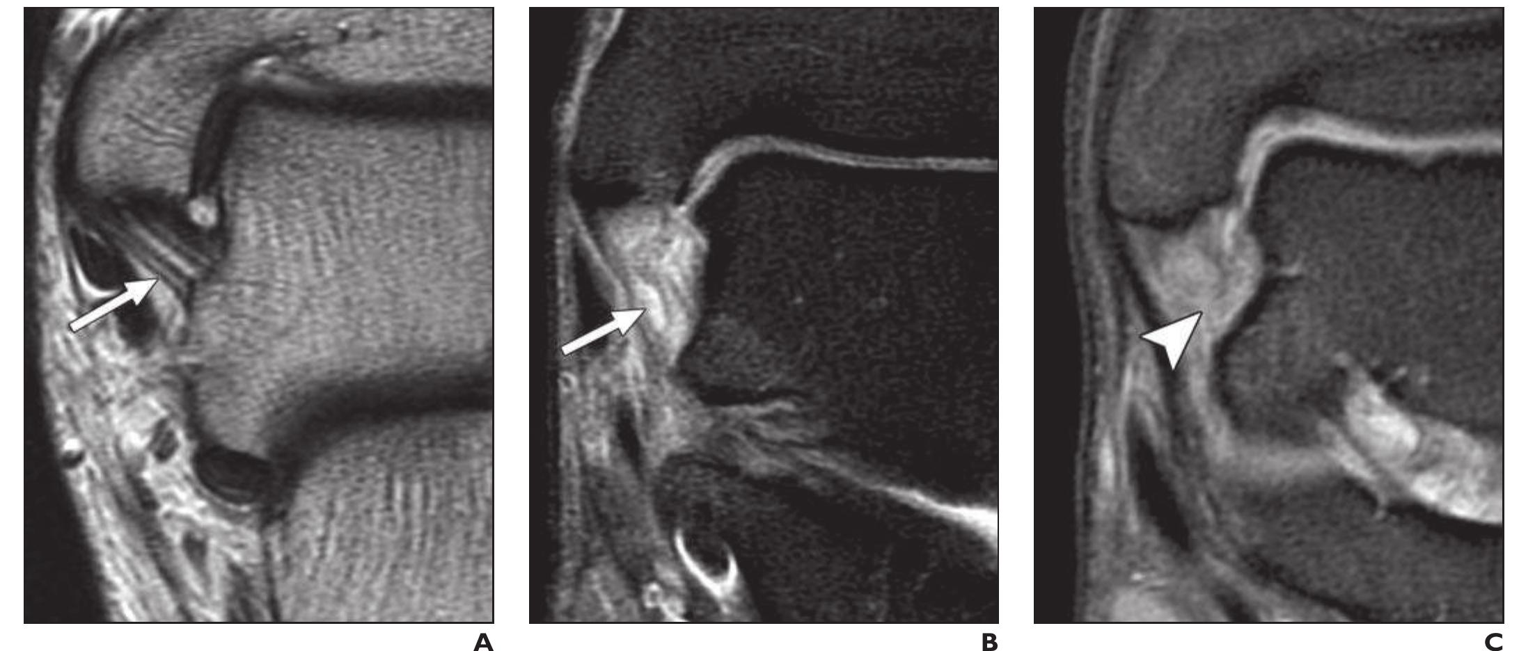 —medial complex and deltoid: posterior tibiotalar ligament.