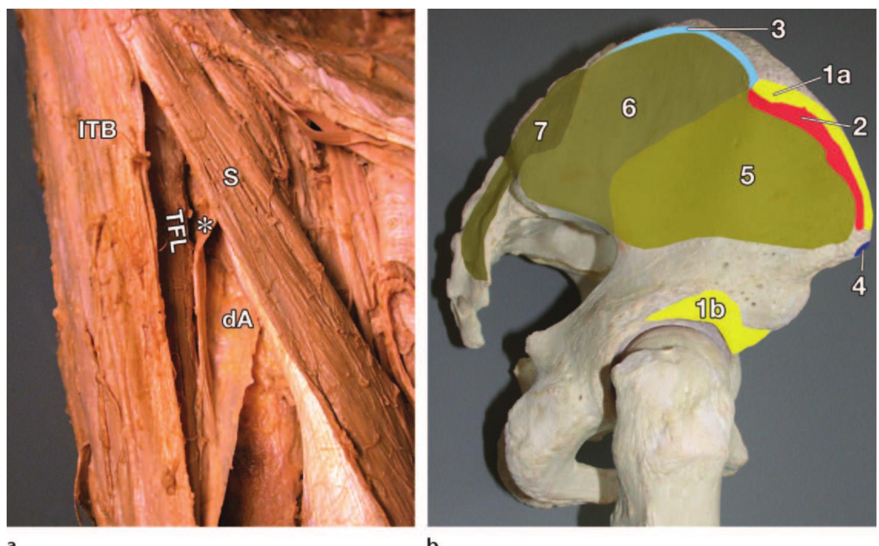 Figure 1 - from Injury of the Gluteal Aponeurotic Fascia and