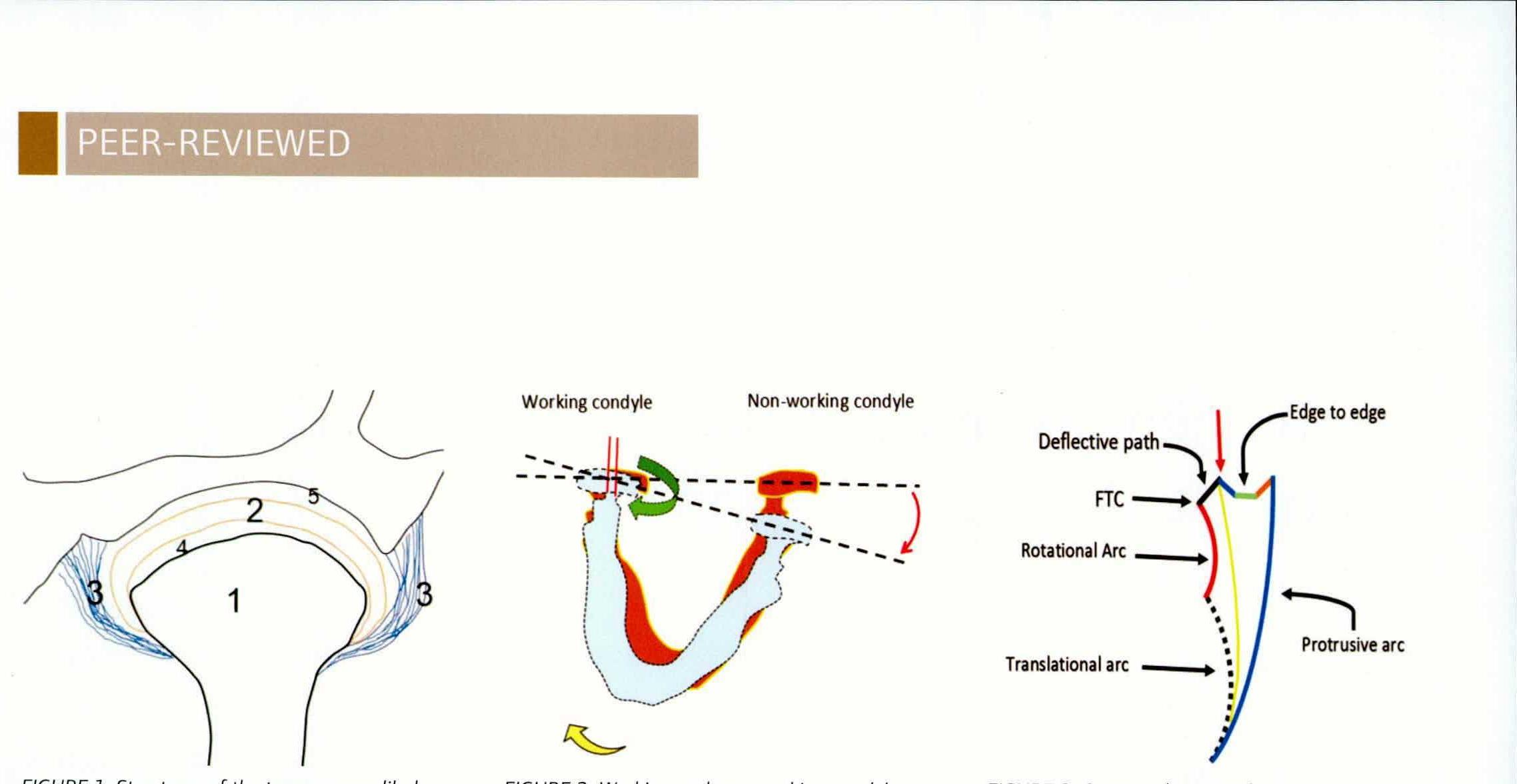 The superior nead or the lateral pterygoid muscle into the