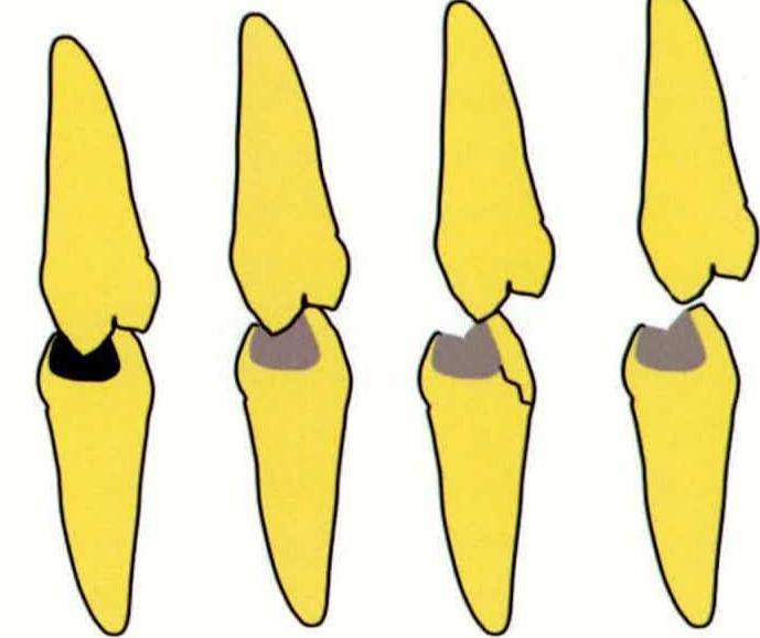 Tilted maxillary palatal cusp is below the curve of wilson.