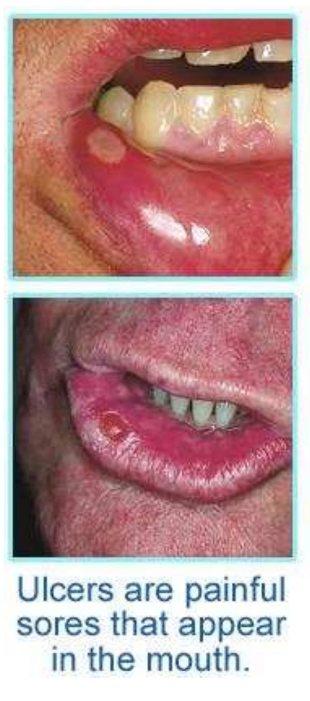 Causes mouth ulcers, also known as canker sores, are most