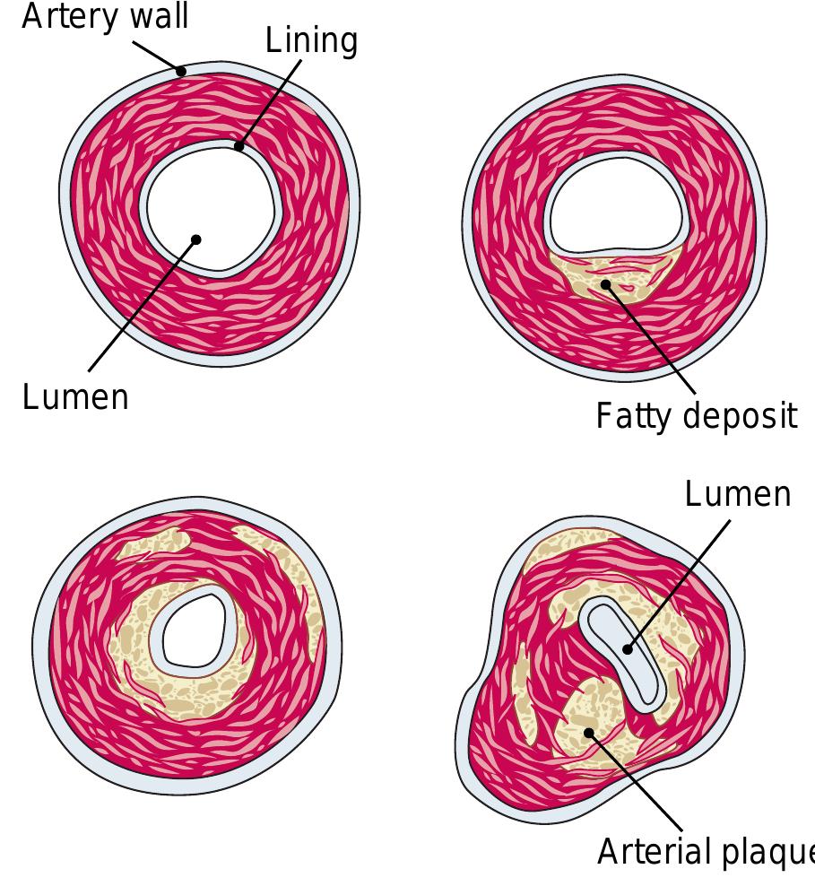 -15 stages in atherosclerosis. blood flow, a variety of