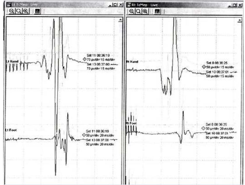 Absent lower extremity transcranial motor evoked potentials