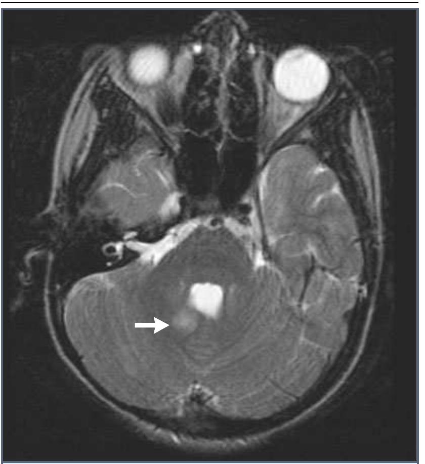 Axial t,-weighted mri of the brain. the arrow shows the area