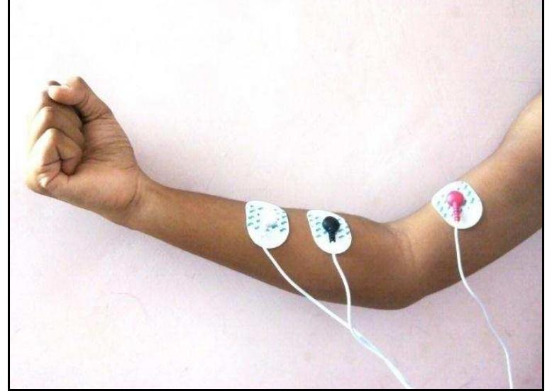 Emg surface electrodes placed on the skin above the muscle