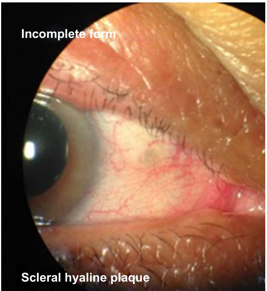 Biomicroscopy of anterior segment — scleral hyaline plaque