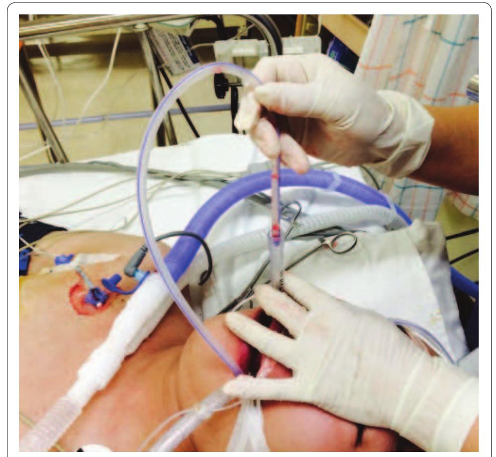 (abstract p204). insertion of a nasogastric tube through an