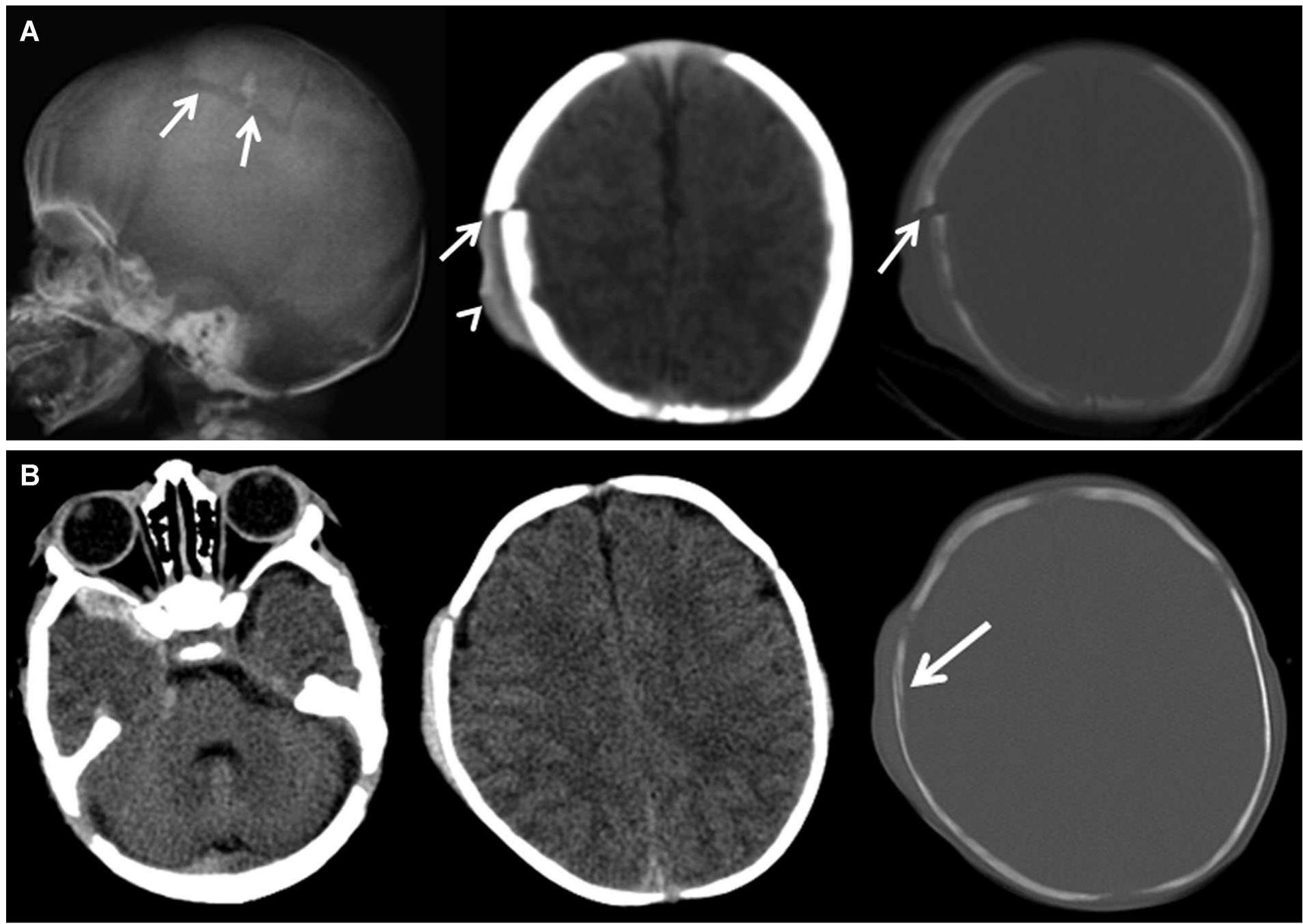 (a) lateral skull radiography and axial ct soft tissue and