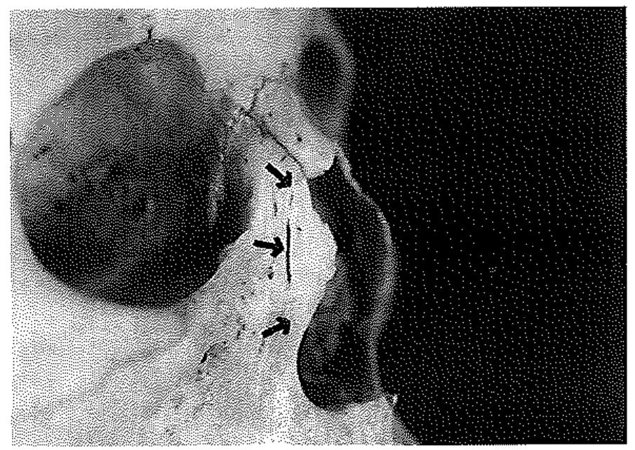 Fracture of the anterior border of the right maxillary