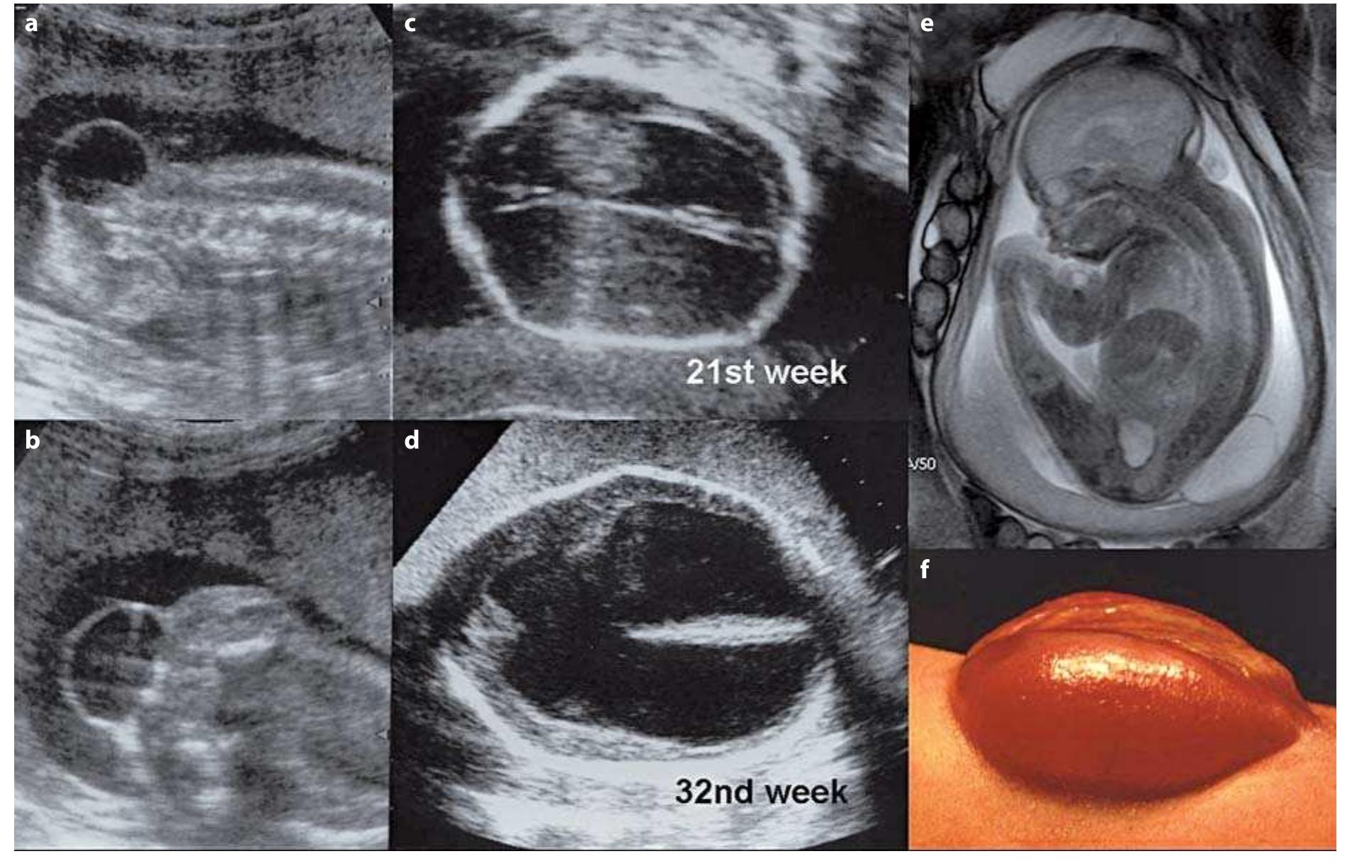 3 a-f. prenatal diagnosis of myelomeningocele. a, b