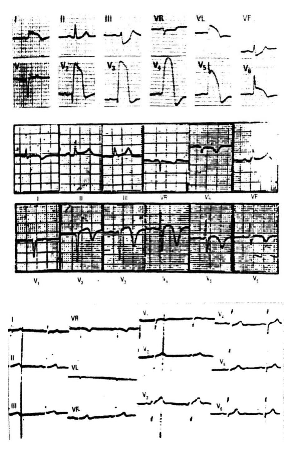 (a) surface ecg of a 65-year-old patient with typical crisis