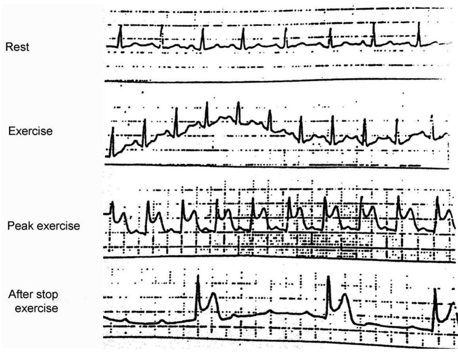 See the appearance of st-elevation with angina at peak