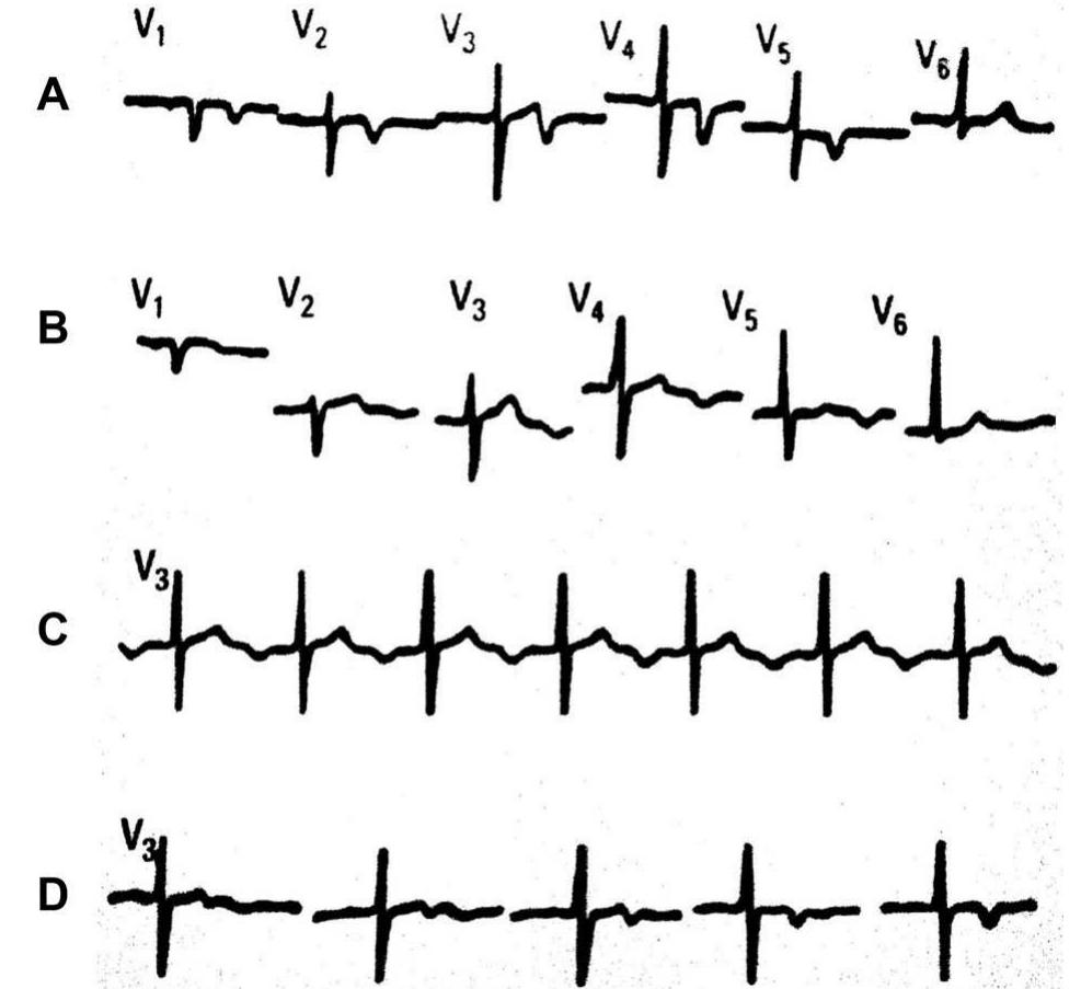 Figure 5 - Prinzmetal Angina: ECG Changes and Clinical