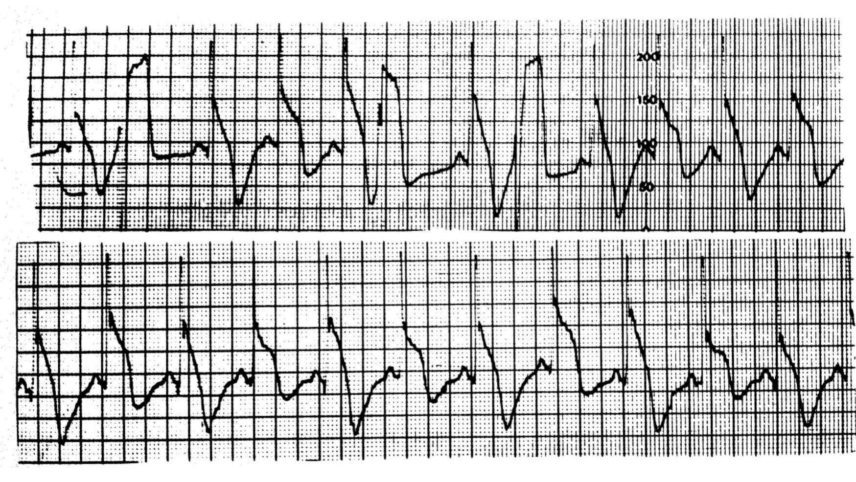 Holter recording of a patient with a severe crisis of