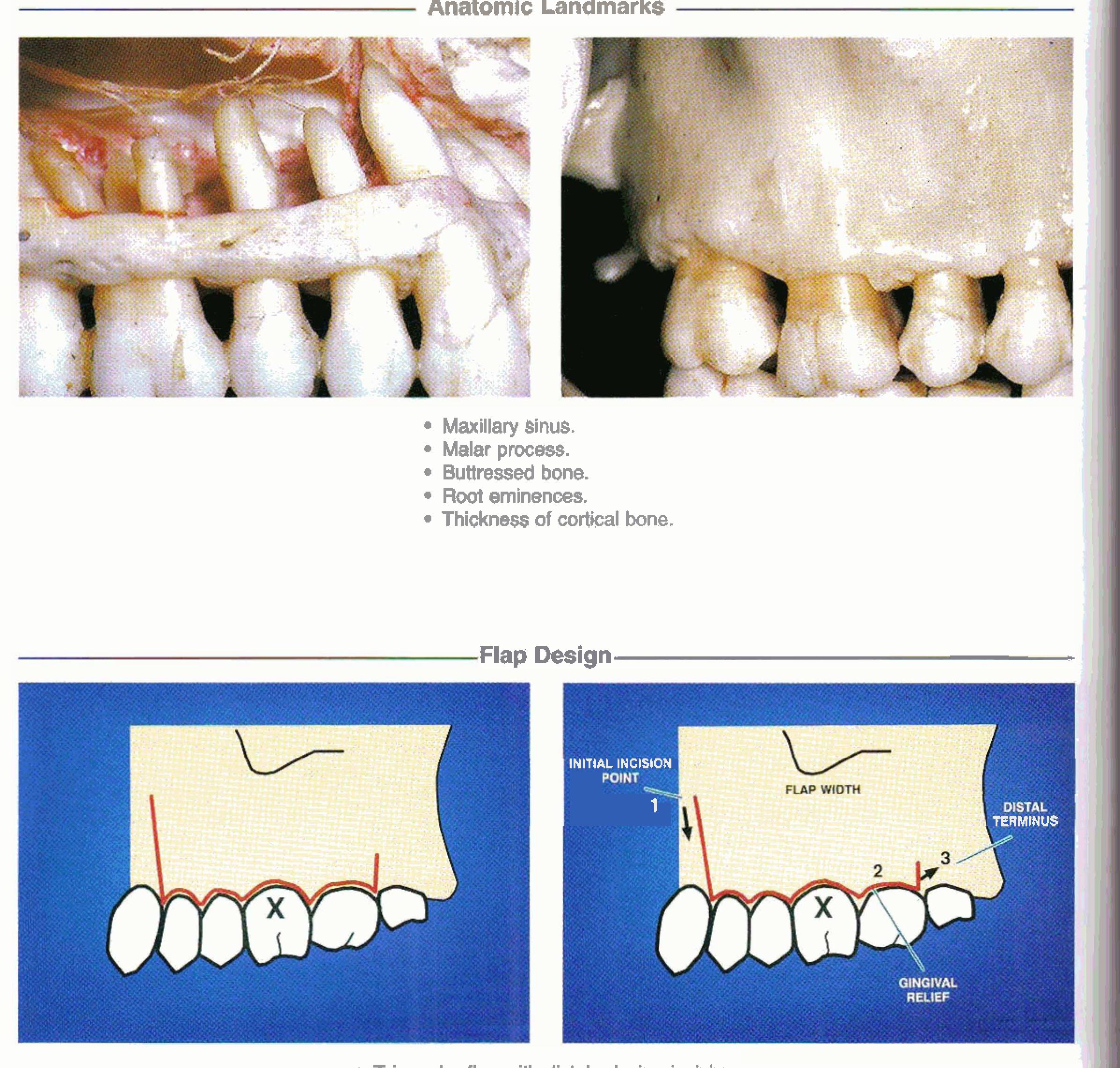 Figure 67 - A Clinical Atlas of Endodontic Surgery