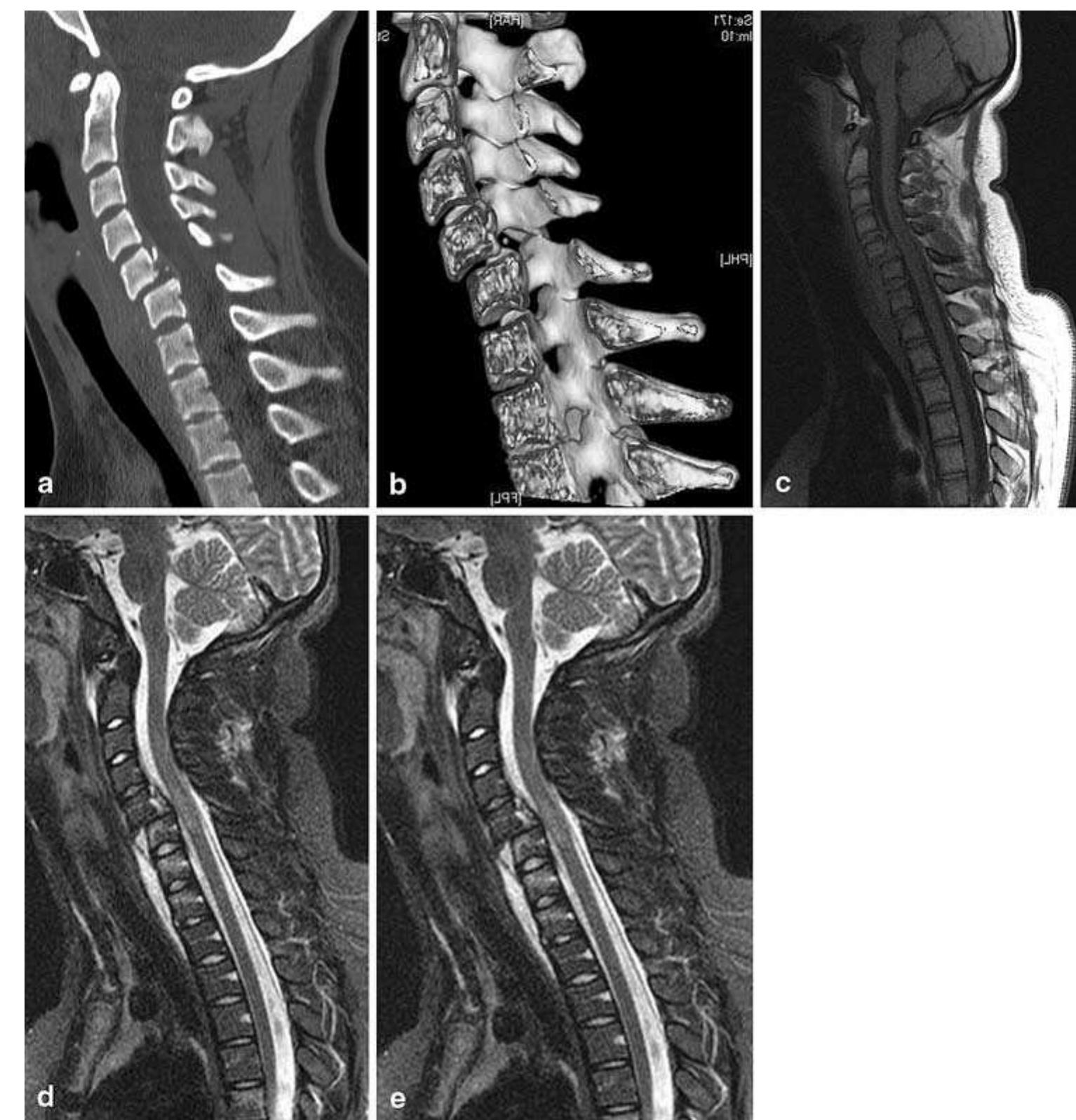 Between pathologic fractures from benign vertebral com-
