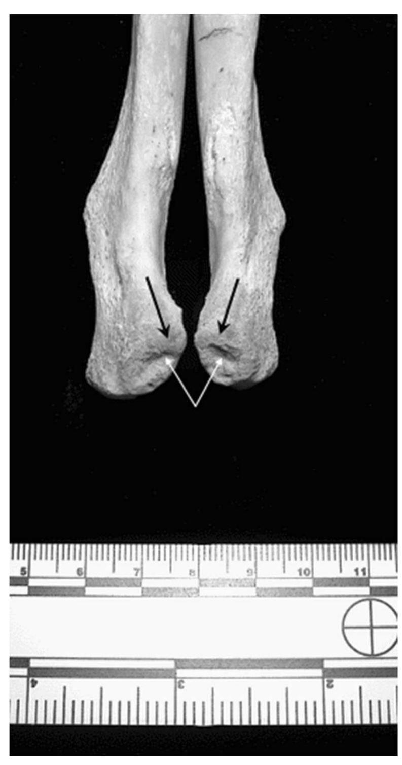 Fusing lateral epiphysis (stage 2). this variant was