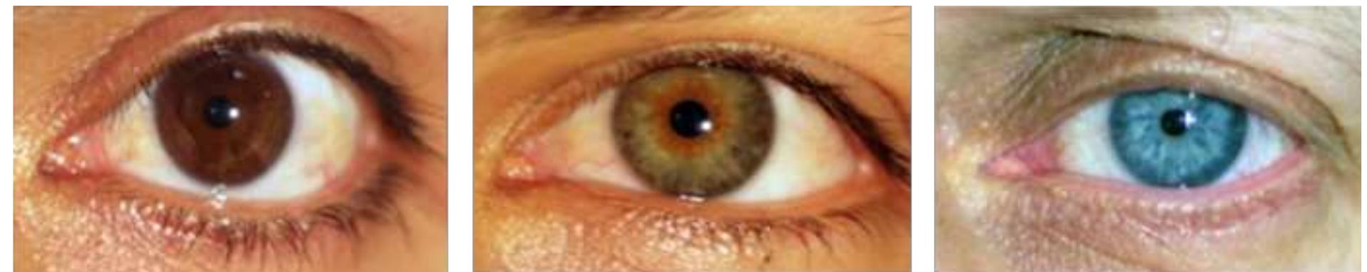 Anatomical sciences figure 1. eye color photos of three