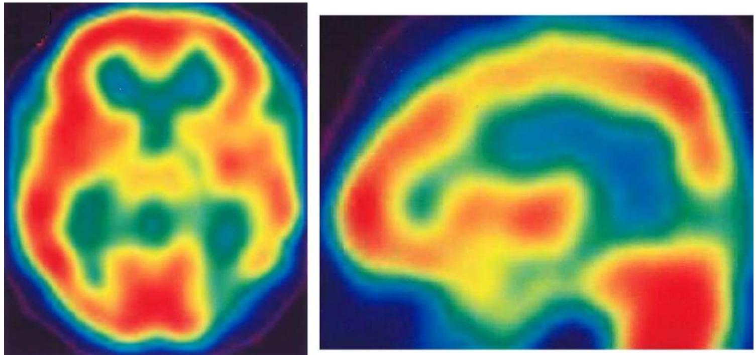 Axial (on the left) and left paramedian sagittal (on the