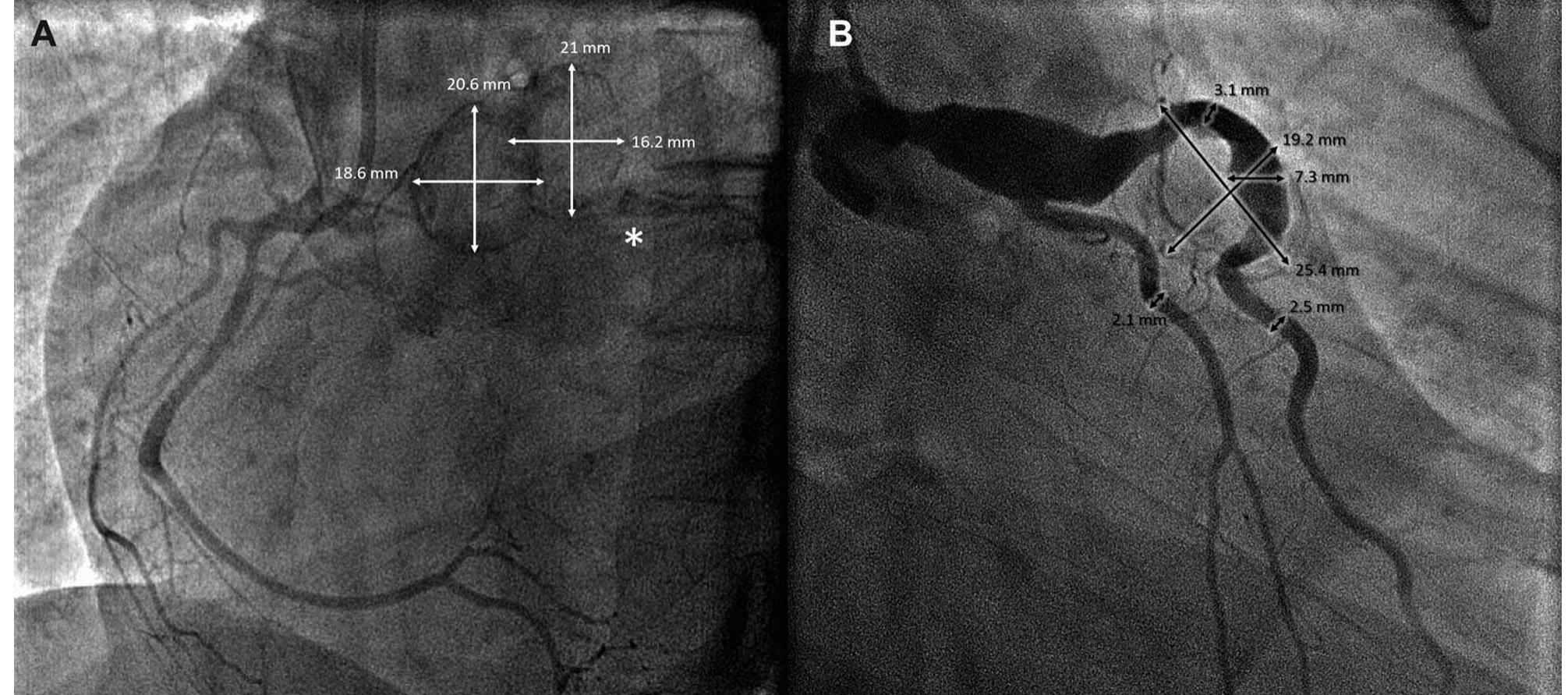 Catheter coronary angiography still frames in a 35-year-old