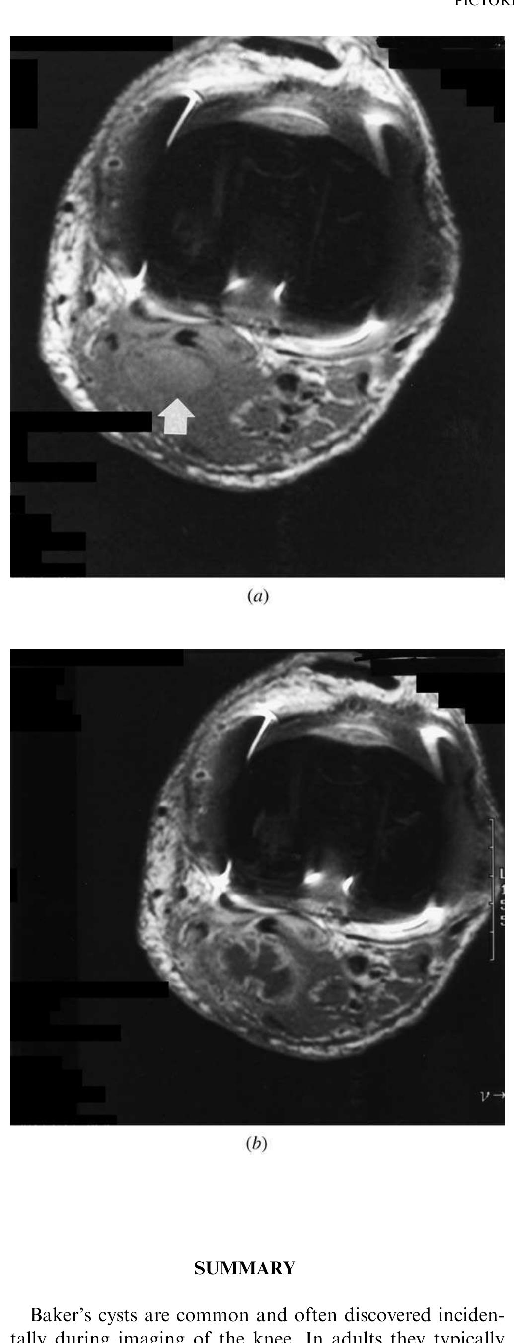 Figure 19 - The Imaging Spectrum of Baker's (Popliteal)