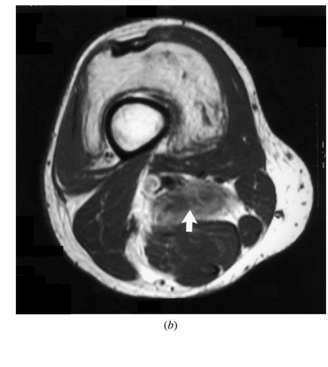 Figure 22 - The Imaging Spectrum of Baker's (Popliteal)